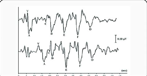 Representative Speech Evoked Auditory Brainstem Responses For A Download Scientific Diagram