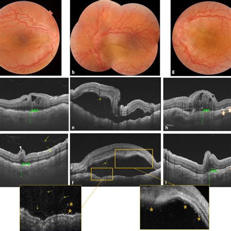 3 × 3 Ss Oct Angiograms Of The Superficial Capillary Plexus A Deep