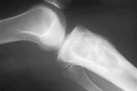 Radiograph Of Large Lucent Areas In Proximal Tibia Of A Year Old Man Download Scientific