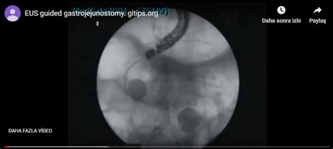 Eus Guided Gastrojejunostomy
