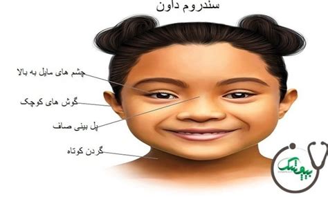 سندروم داون چیست؟ علت، درمان، تشخیص قبل از تولد بیچشک