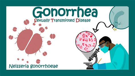 Gonorrhea Signs Symptoms And Complications 60 Off