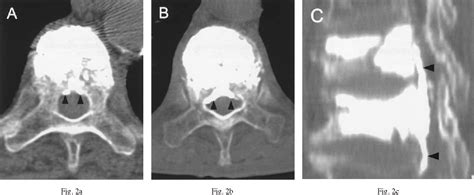 Compression Fracture Semantic Scholar