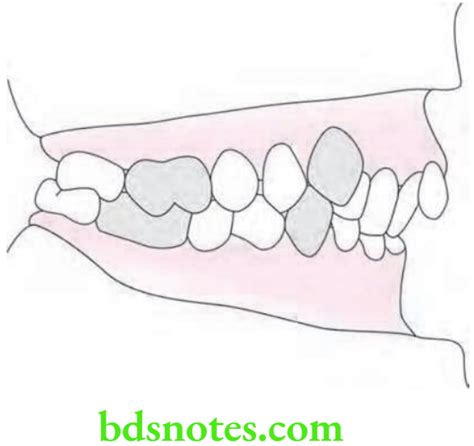 Classification Of Malocclusion Question And Answers Bds Notes