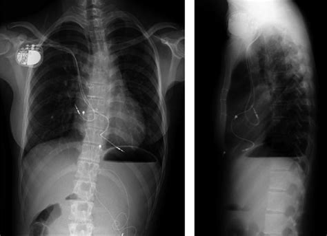 Chest X Ray Taken 7 Years After Transvenous Pacemaker Implantation When