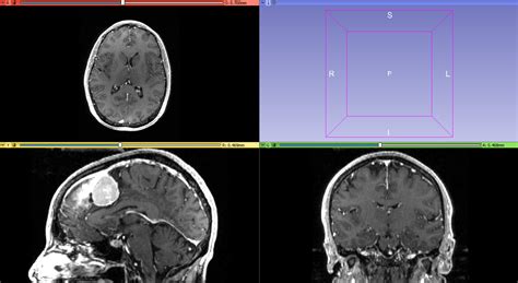 Overview D Slicer Segmentation Recipes