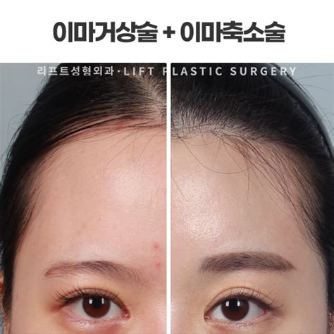 수술 일기 11 이마거상과 이마축소를 한번에 더블이마축소술 헤어라인 흉터 장기적 경과 대구 리프트성형외과ㅣ리프팅수술ㅣ이마거상ㅣ안면거상
