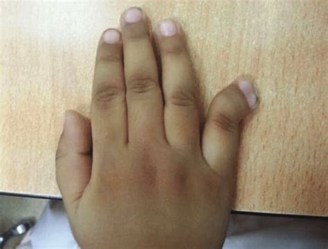 Unilateral Ulnar Polydactyly Download Scientific Diagram