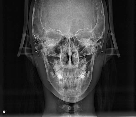 Нүүр амны рентген зургийн төрлүүд