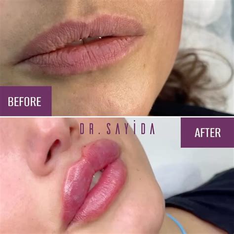 Lip Filler You Can Contact Us For Information Or For Your Free