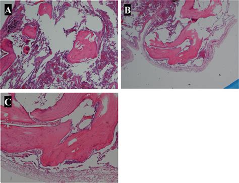 Histopathology Slides Showing Multiple Pulmonary Ossifications A