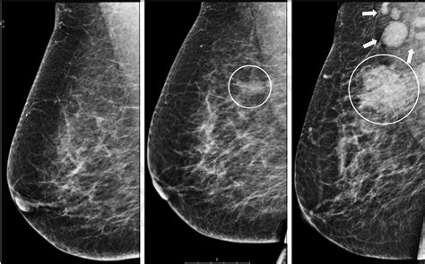 New Research Shows Consequences Of Delayed Diagnosis In Mammography Screening