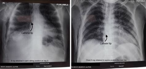 Cxrs Obtained In Semi Sitting And Supine Position Compared Cxr Chest Download Scientific