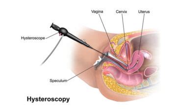 How To Test If A Woman Is Infertile Dr Rhythm Gupta Excel IVF