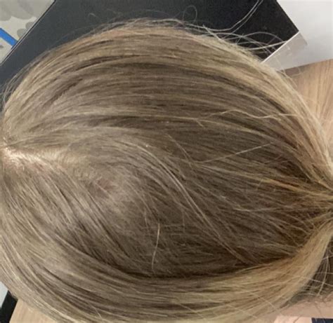 Te Three Months Apart Rtelogeneffluvium