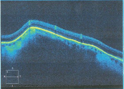 Sclerochoroidal Calcification Leads To Diagnosis Of Primary Parathyroid Cancer Published In