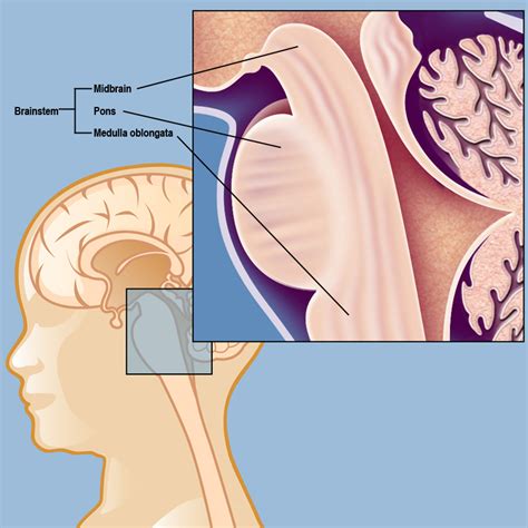 Diffuse Intrinsic Pontine Glioma DIPG Weill Cornell Brain And Spine Center