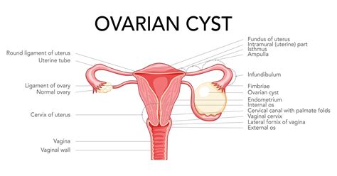 What Is Cyst Meaning In Hindi Cyst Kya Hota Hai Dr Mona