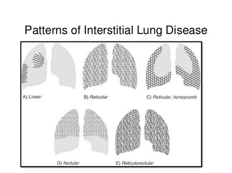 Approach To Interstitial Lung Diseases