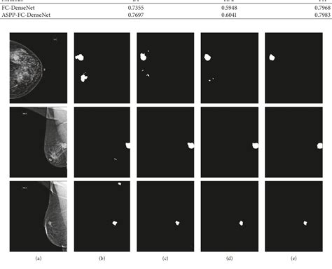 Figure 1 From Fully Convolutional Densenet With Multiscale Context For Automated Breast Tumor