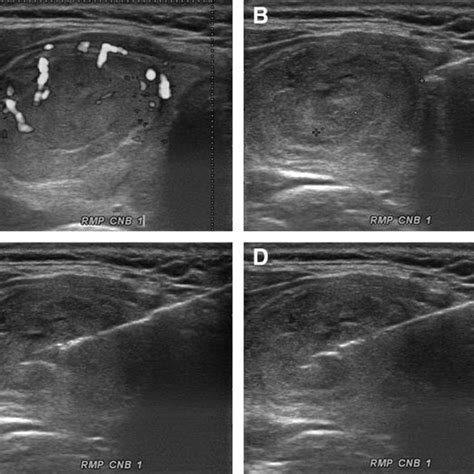 US Images Of A Year Old Female With A Thyroid Nodule Evaluated By Download Scientific