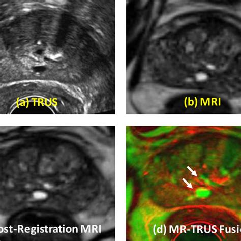 The Mr Trus Prostate Registration Diagram The Prostate Gland Is Shown