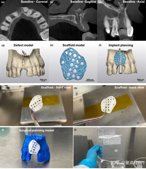 研究人员使用3d打印骨支架重建颌骨，无需二次手术即可移除支架 知乎