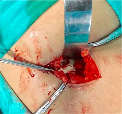 Intraoperative Abscess On Exploration Of Perforated Stump Appendix Download Scientific Diagram
