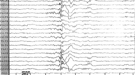Electroencephalogram Of Patient K Two Months After Recurrence Download Scientific Diagram