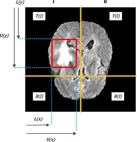 Brain Tumor Detection By Fbb In Flair Mr Modality From Brats 2017
