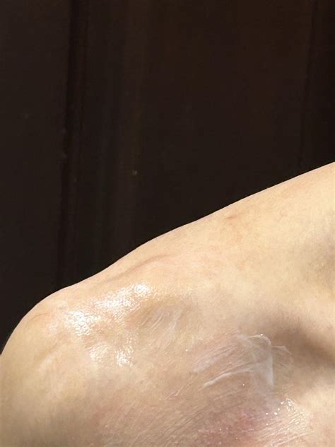 Acromioclavicular Dislocation R Medical Advice