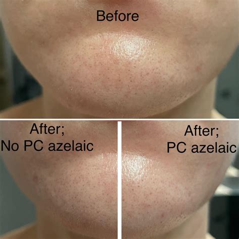 Banda 41f Two Months Of Pc Azelaic Acid Booster On One Side Of Chin