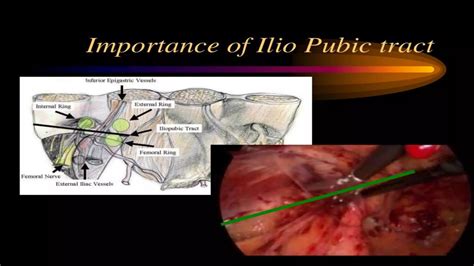Laparoscopic Anatomy Of Inguinal Hernia Pptx