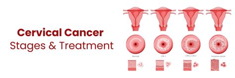 Treatment For Cervical Cancer For All Stages