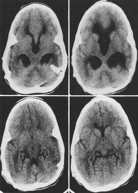Perimesencephalic Cistern