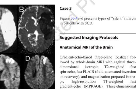 Ischemic Vs Hemorrhagic Stroke Mri