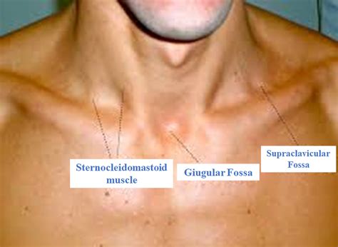 Anatomy Shoulder And Upper Limb Supraclavicular Fossa Treatment