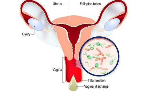 Yeast Infection Discharge Cottage Cheese What Your Vaginal Discharge