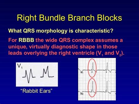 Ecg Part 8