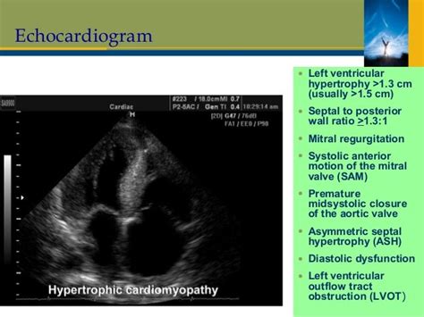 Myocarditis Echo Findings Myocarditis The Disease Is Commonly