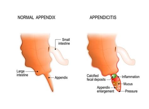 What Is The Use Of Appendix In Human Body
