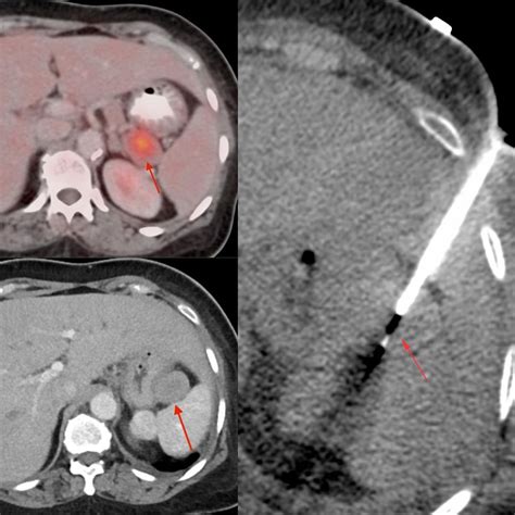 Trans Organ Biopsy Trans Hepatic Biopsy Of A Gist Ref India