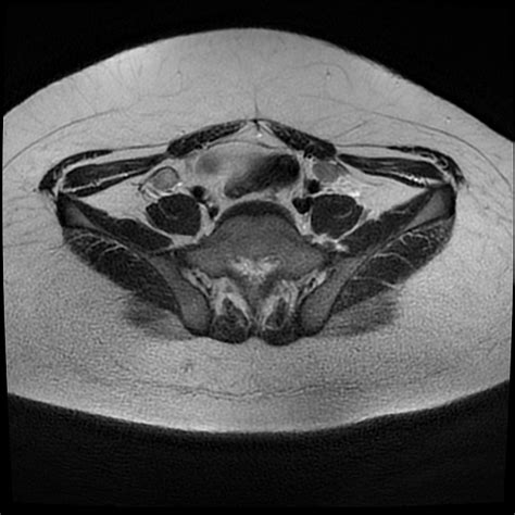 Radiopaedia Case Male Pseudohermaphroditism Id 61533 Study 69501 Nc