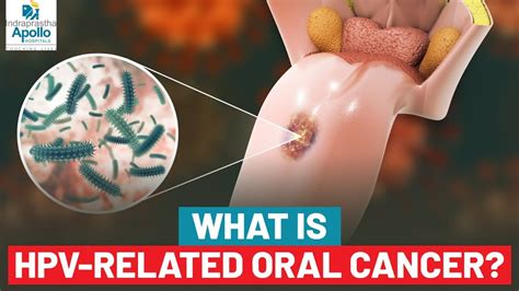 Hpv Related Oropharyngeal Cancer