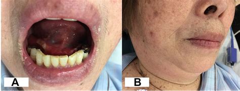 Swelling On Floor Of Mouth Under Tongue Treatment