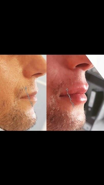 تزریق فیلر لب برای آقایان؟؟ Youtube