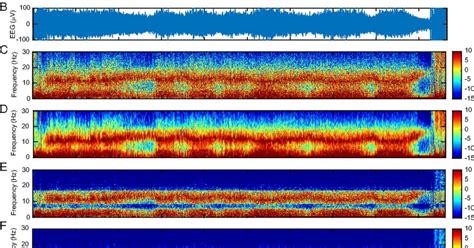Eeg Monitoring Of Anesthesia Picower Institute