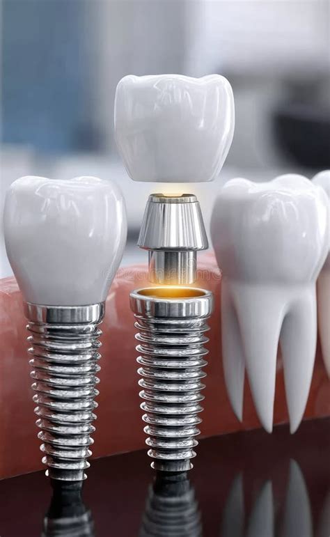 Implant Tooth Method Surgical Fixture Molar Replacement Gum Grafting Structural Post Oral