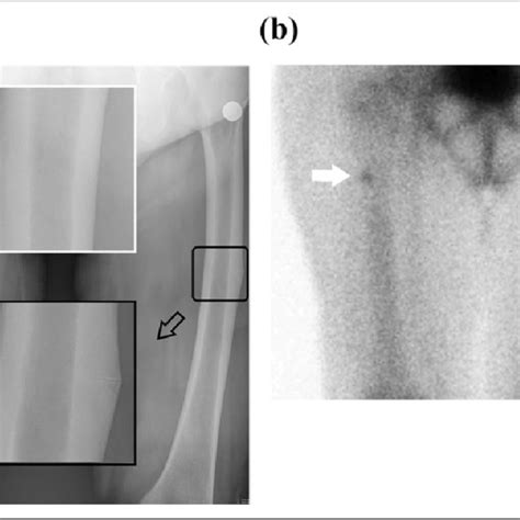 Radiograph Depicting A Proximal Femur Fracture With Features Indicating