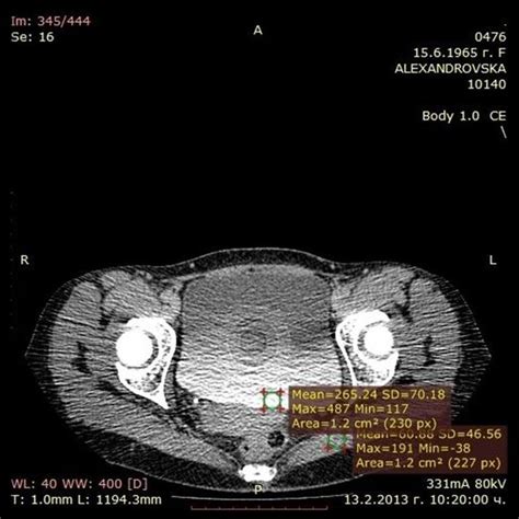 Evaluation Of Axial Vertebral Rotation In 2d Images A Cobb Method Download Scientific Diagram